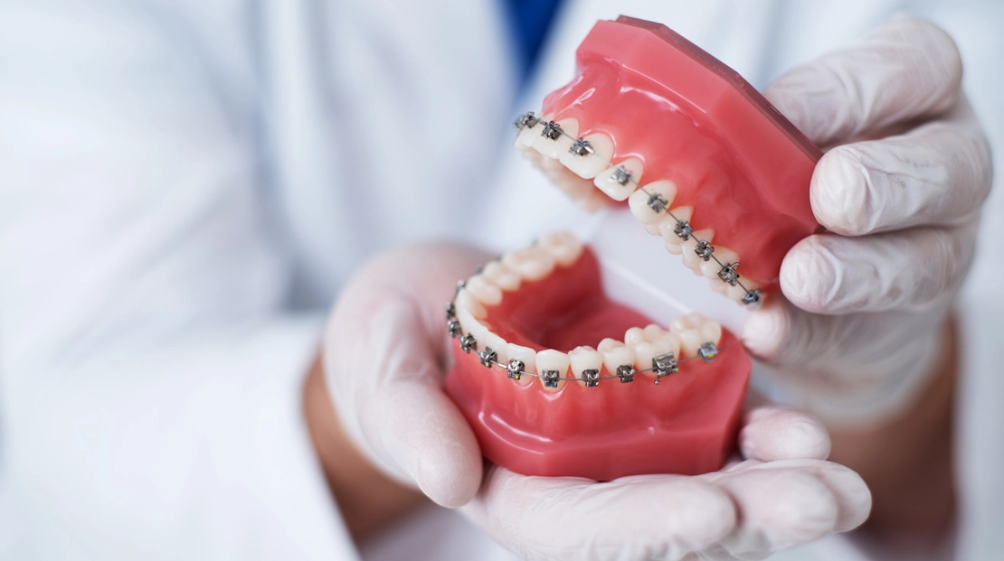 Understanding How Do Braces Move Teeth?