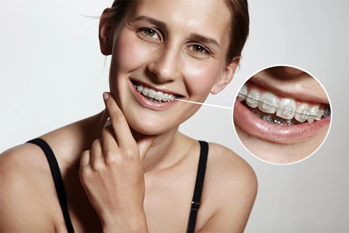 Ceramic Braces vs Metal Braces: Your Guide to Braces Selection