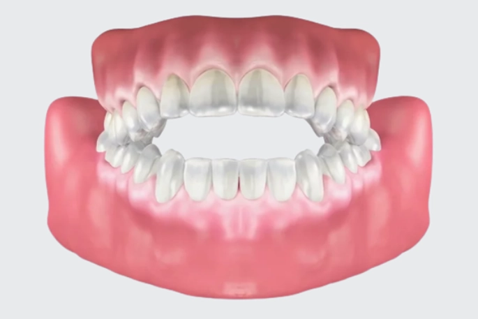 What Is an Open Bite Teeth? Causes, Types & Treatments