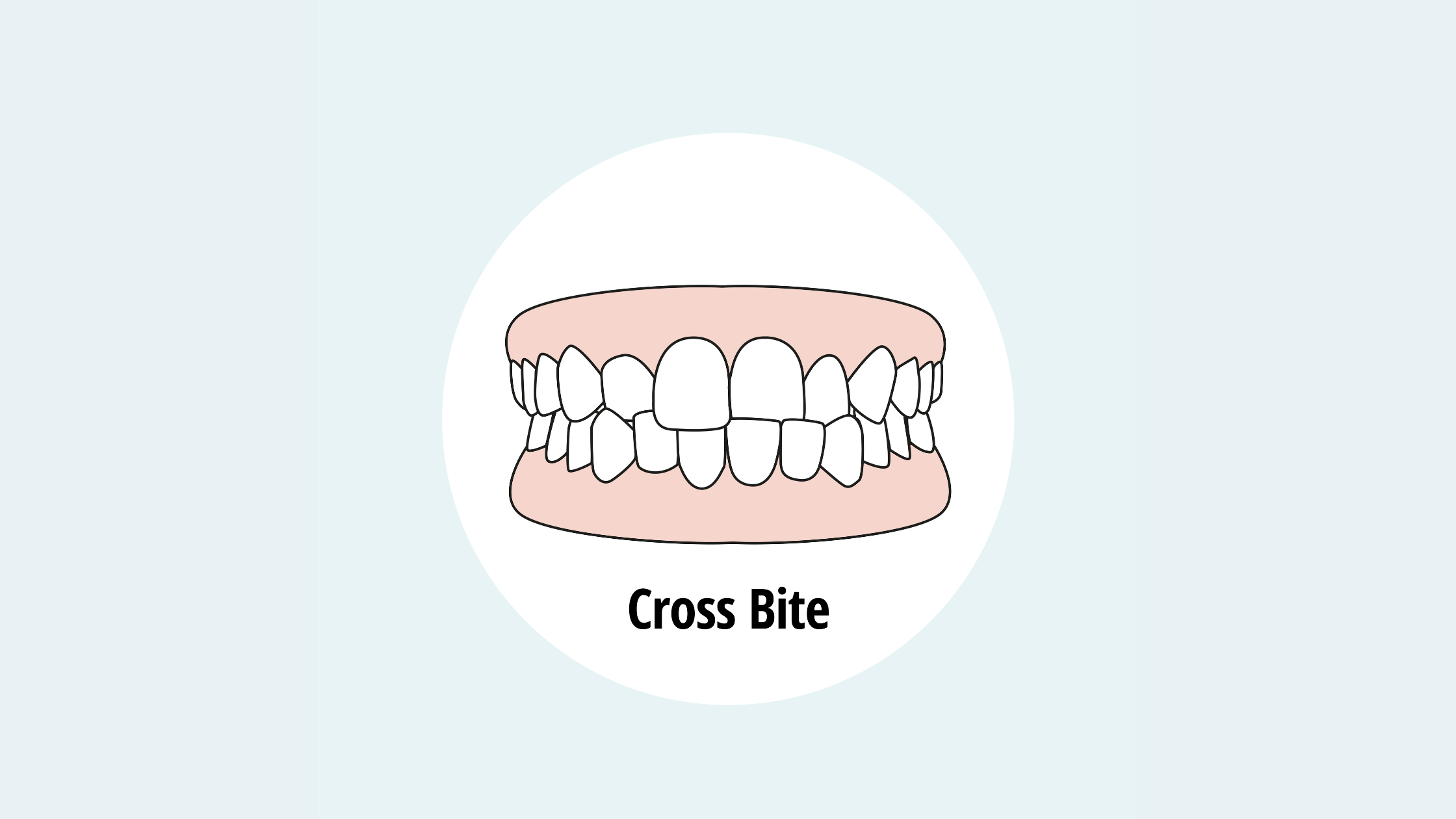 Can Invisalign Fix a Crossbite? Benefits, Treatment & Results