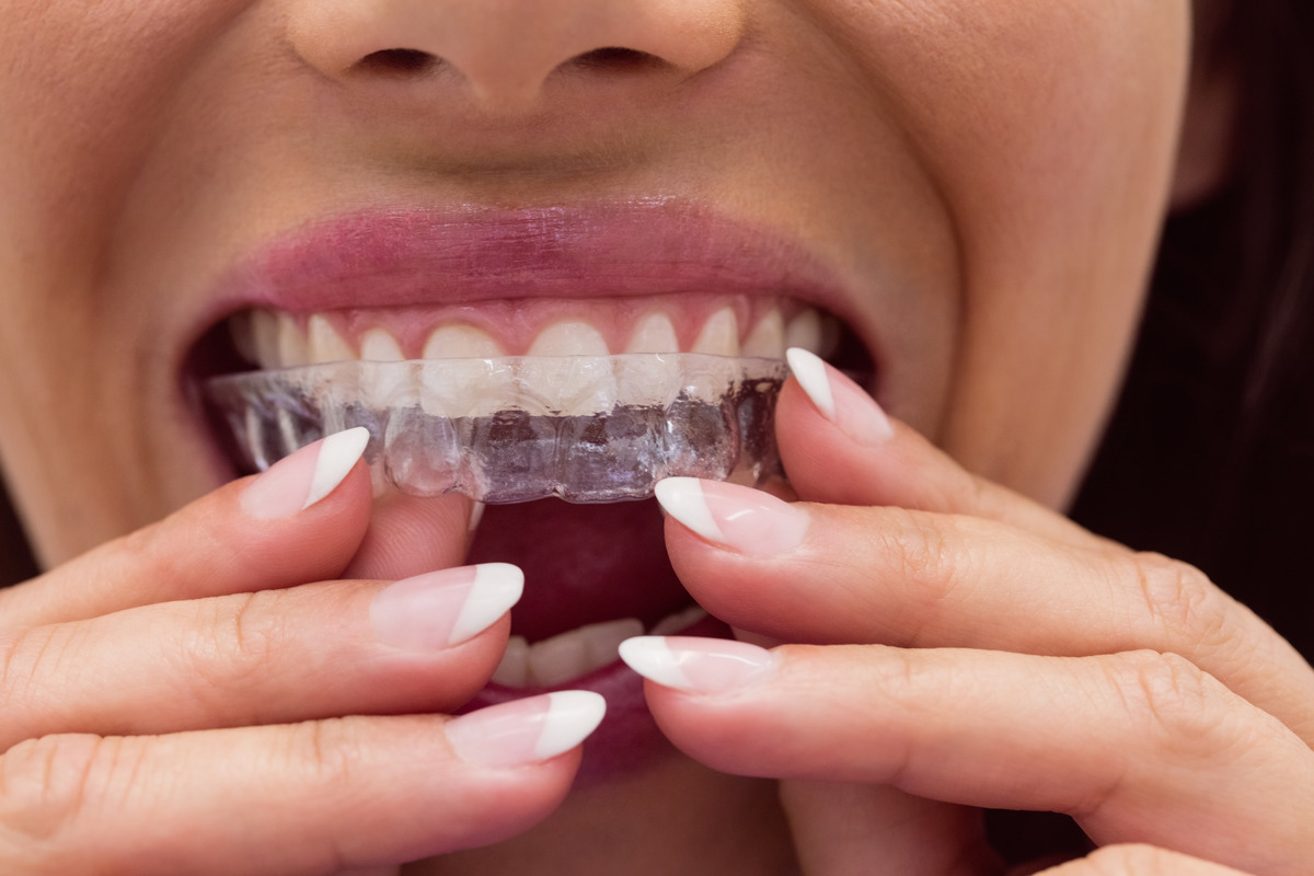 Invisalign: How Long Does It Take To Straighten Teeth?