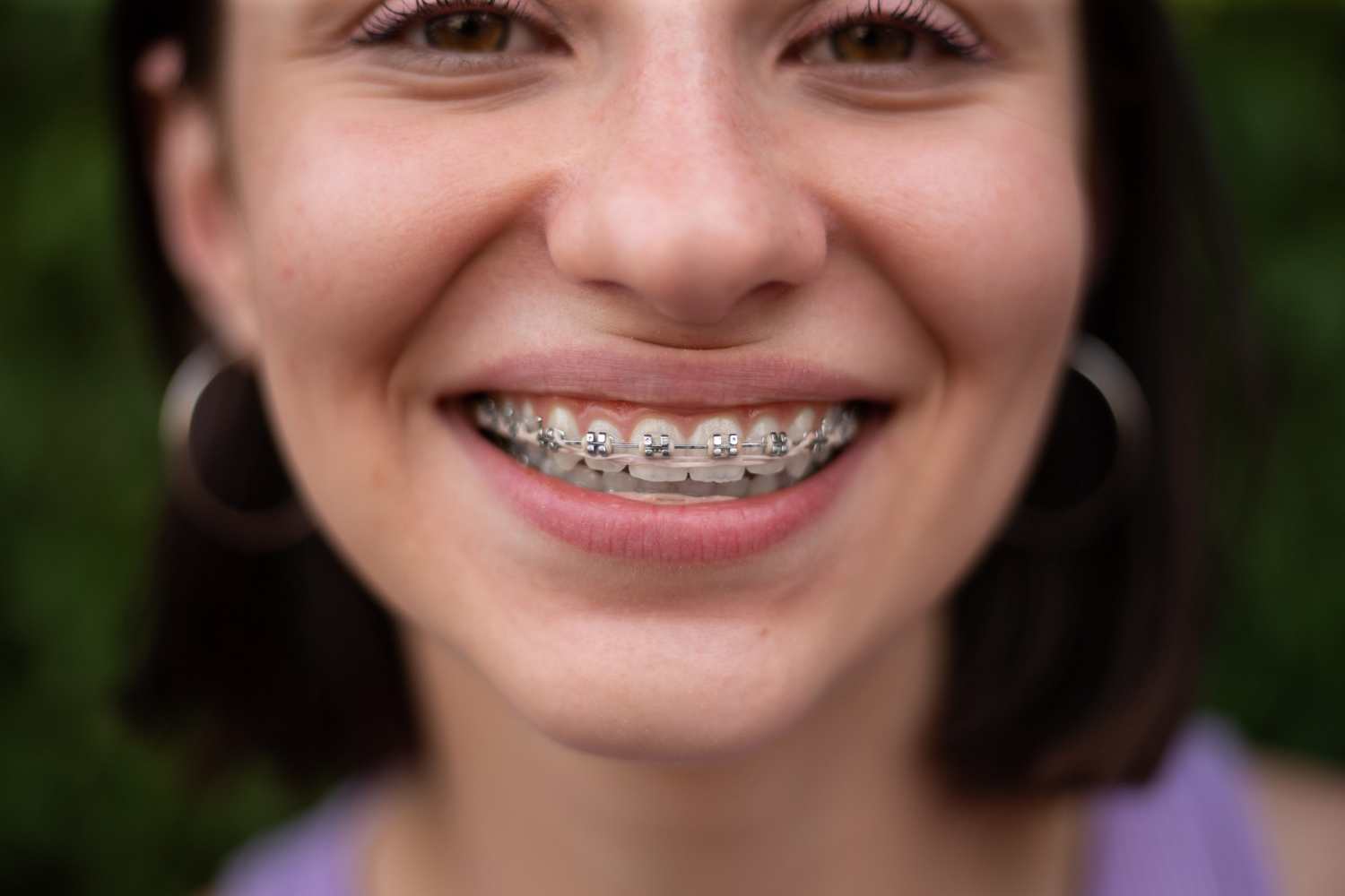 Can Braces Fix Asymmetrical Face - Unlock Your Perfect Smile