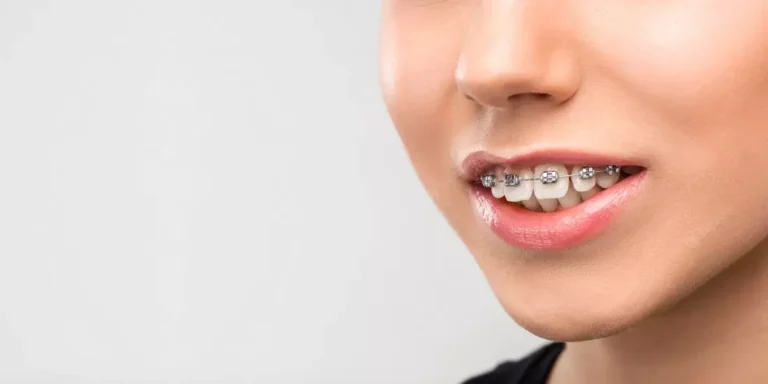How to Fix an Overbite – Causes, Types & Correction - Brite Orthodontics