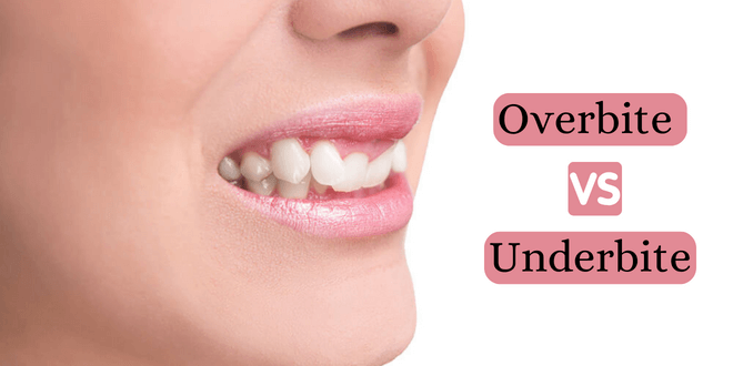 Overbite vs Underbite: Key Differences & Treatment Options