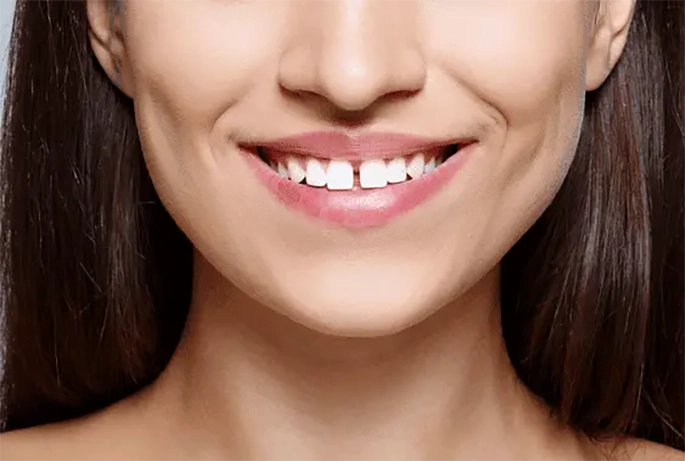 Diastema (Gap Between Teeth): Causes, Symptoms & Treatment