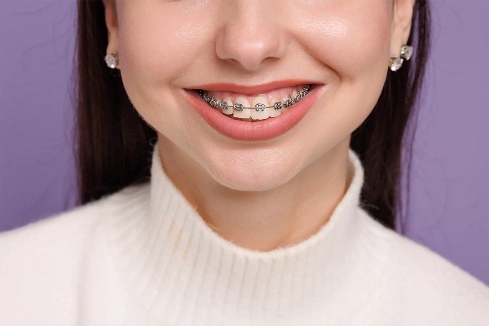 Can Braces Fix Overbite? & How Do Braces Fix Overbite?