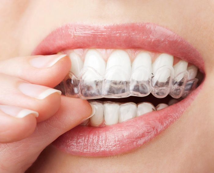 Invisalign Buttons vs Attachments - Key Differences Explained